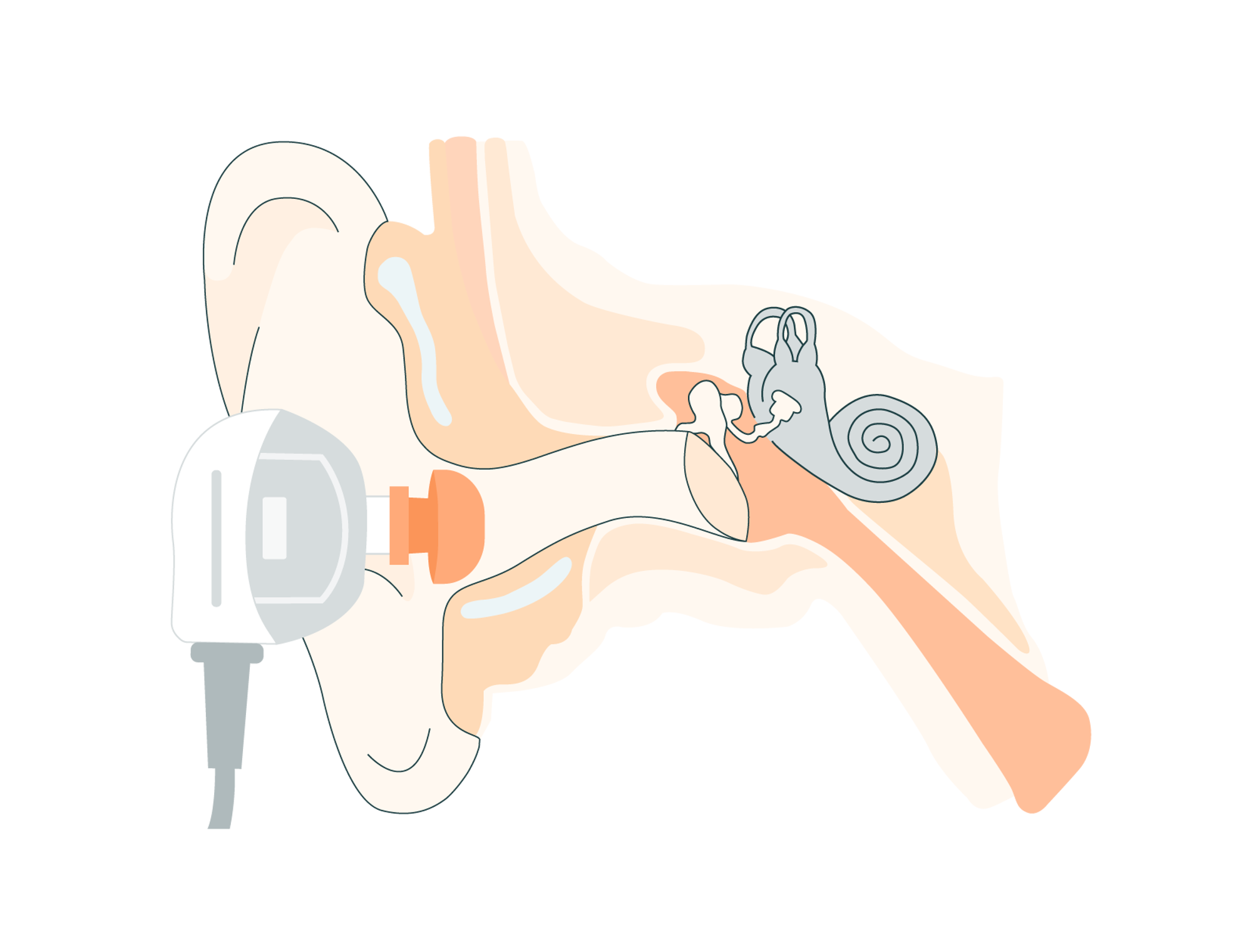 Otoacoustic Emissions (OAE) Tests & Best Practice Guide