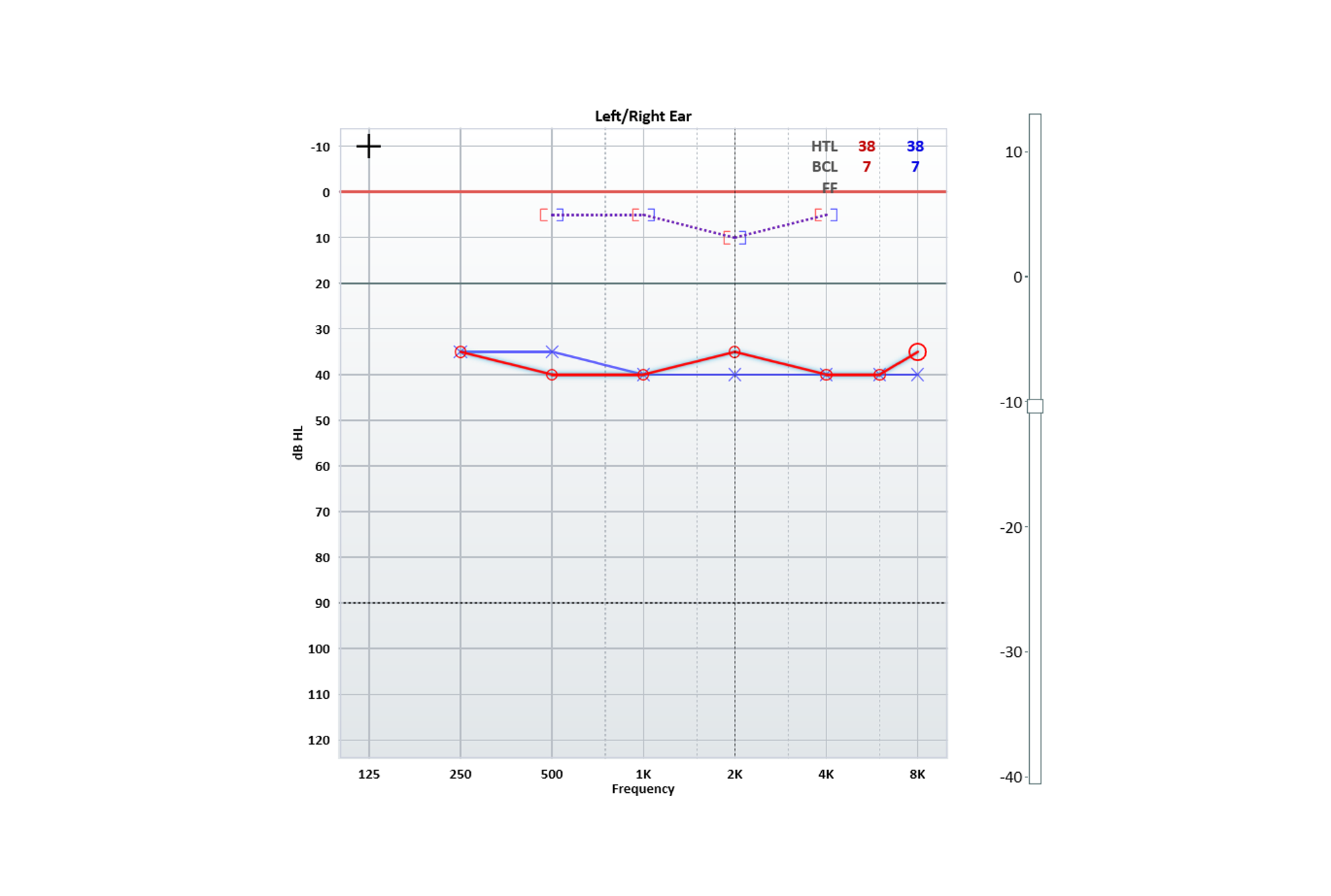 What Is the Air-Bone Gap? Understanding Hearing Loss
